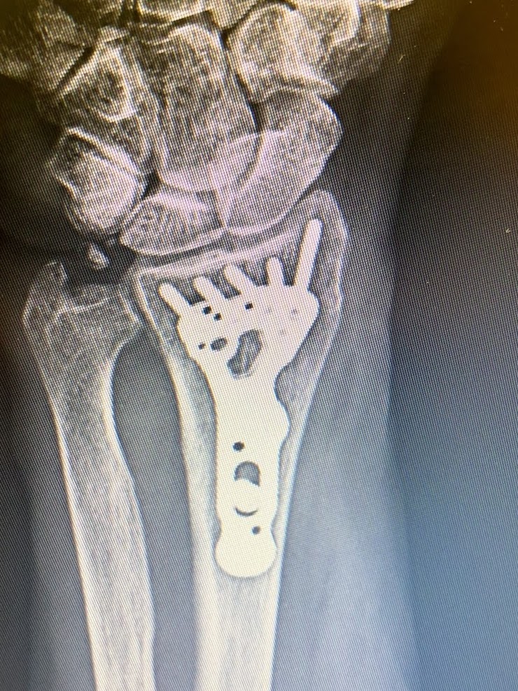 Volar plate (1) - Jackson Orthopaedics